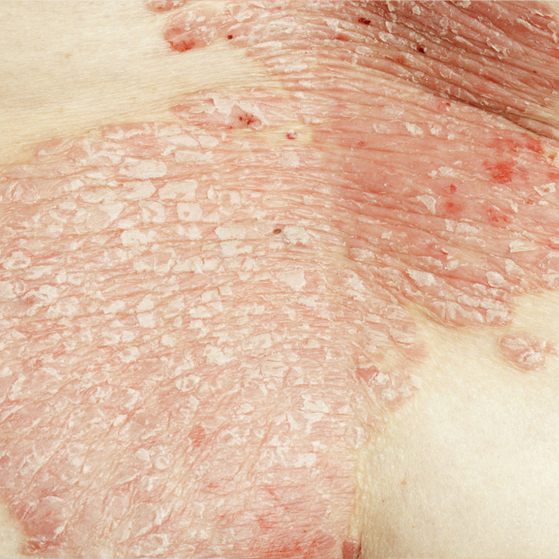 Types of Psoriasis