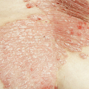 Types of Psoriasis