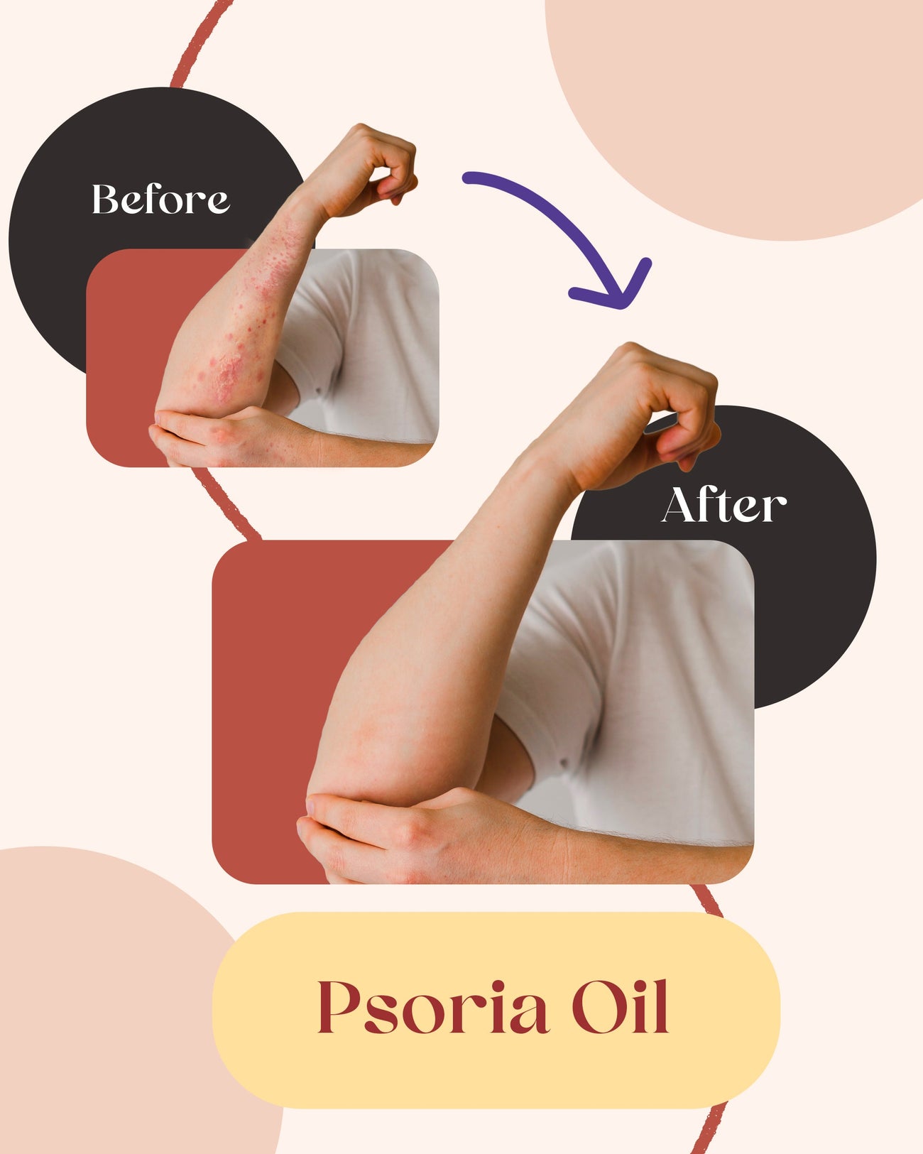 Siya Ayurveda Psoria Oil | Oil for Scalp and Full Body Psoriasis