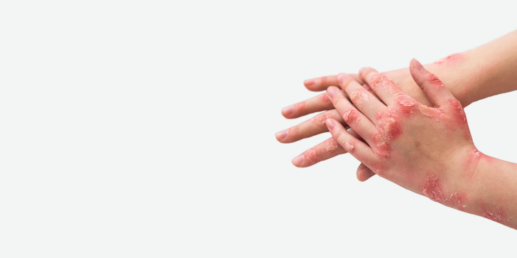 Types of Psoriasis