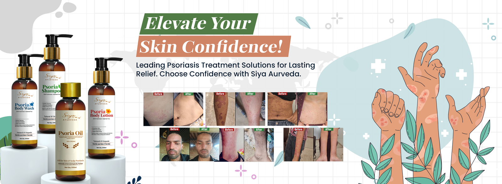 Psoriasis Treatment Products for Skin Relief