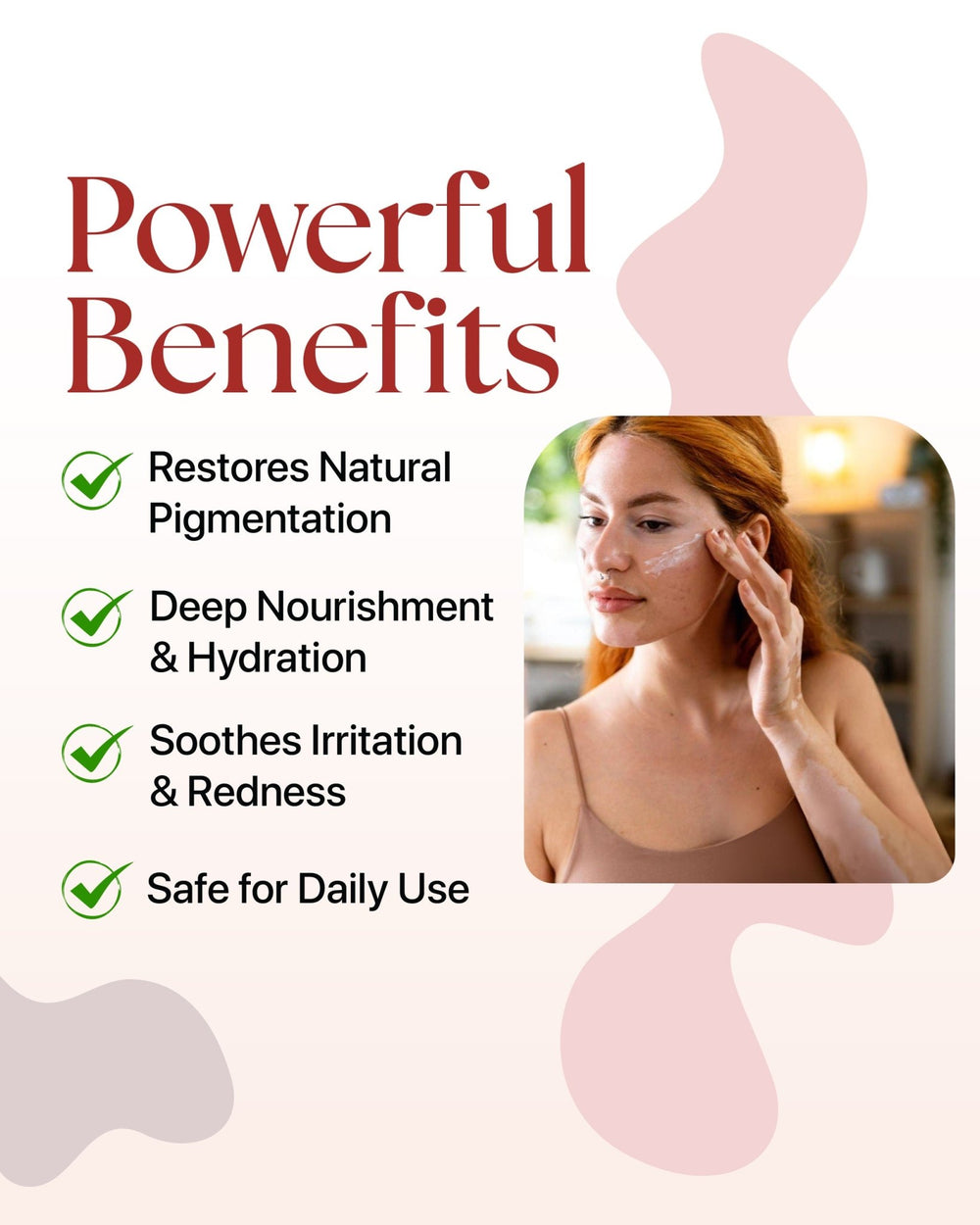 Siya Ayurveda VitiCalm | Cream for Vitiligo and White Patches